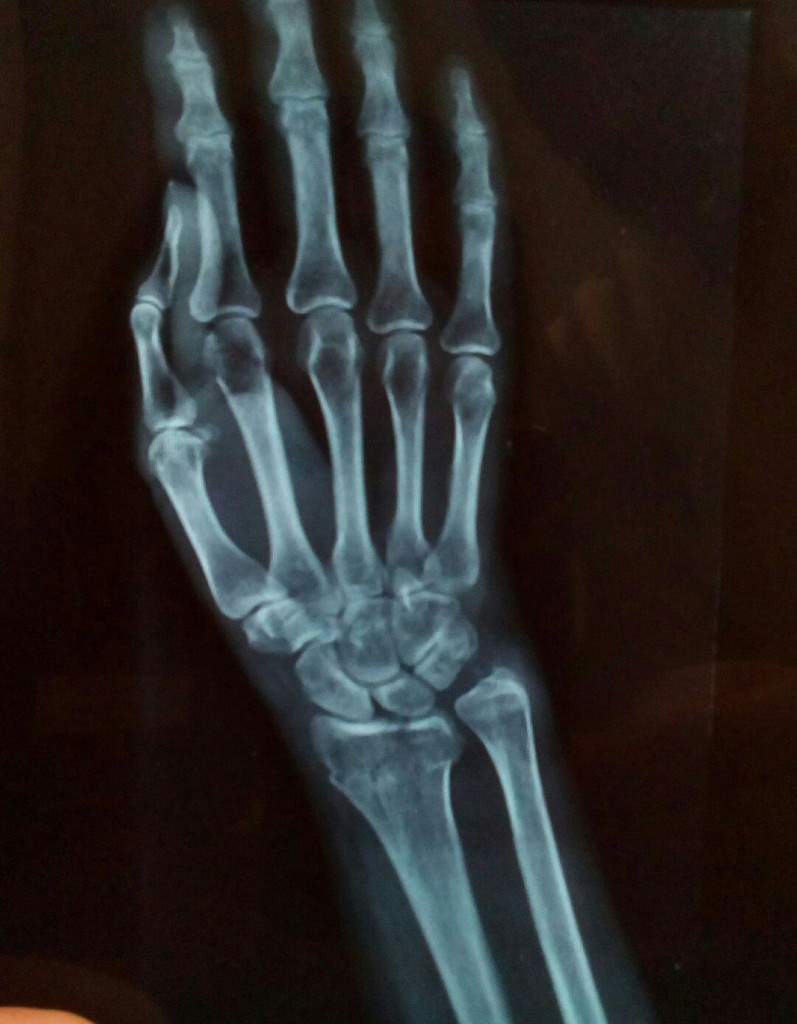 La fractura de Colles - Corporación Fisiogestión