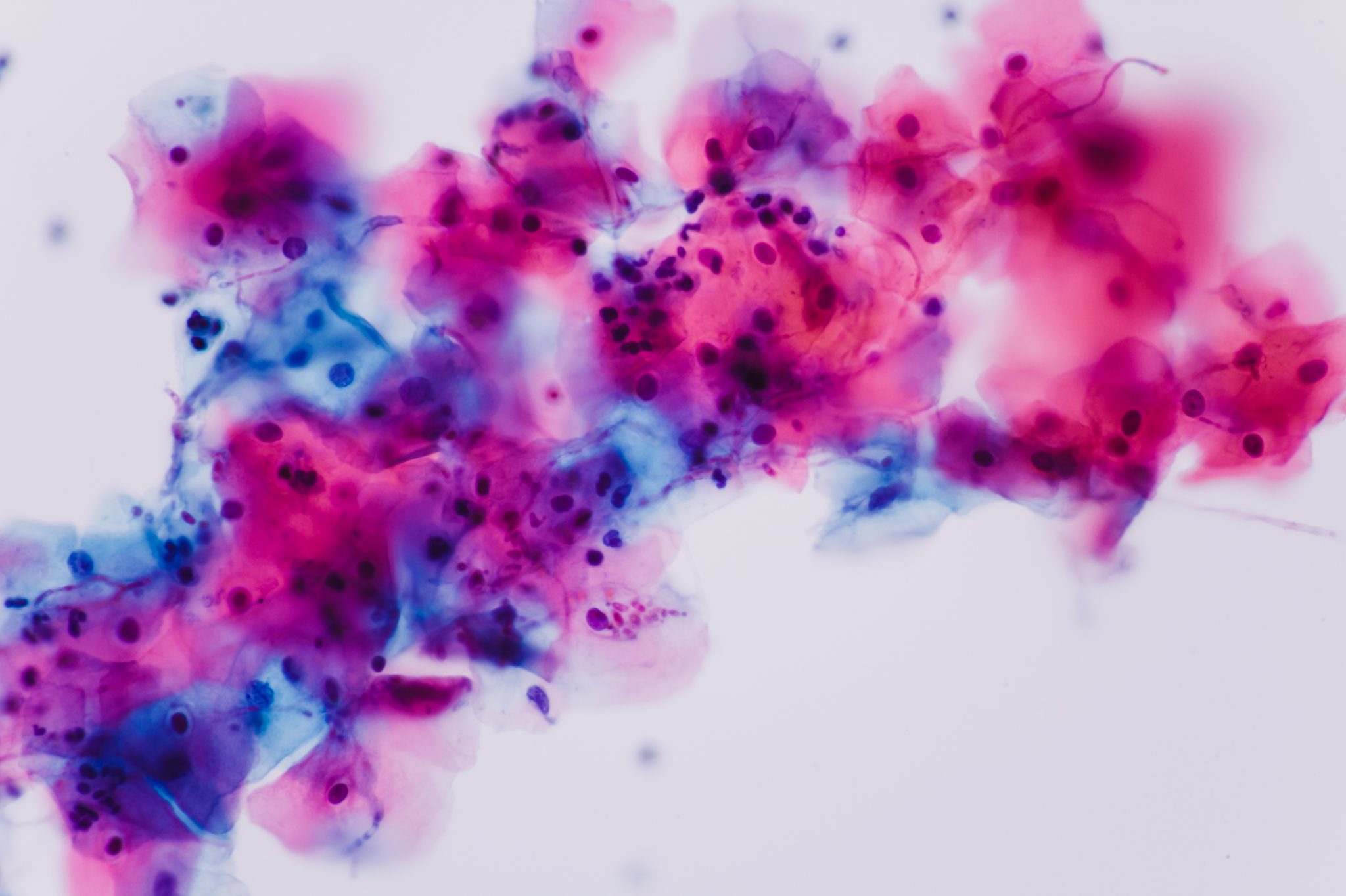 ¿Qué es la candidiasis vaginal? - Corporación Fisiogestión